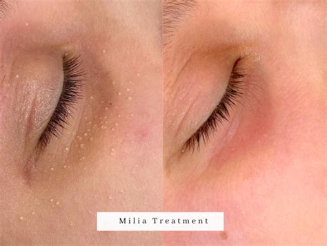 Milia Treatment Skin Clinic Bolton Hifu Rf Microneedling Skin Tag