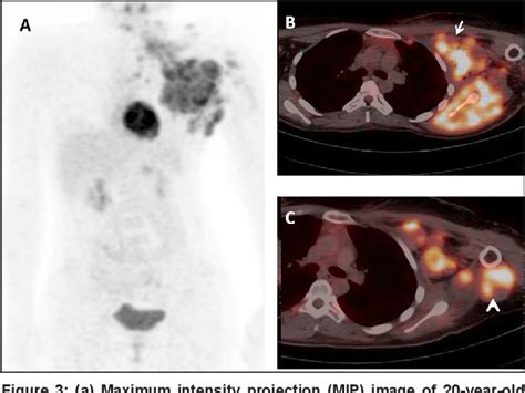 Figure 1 From Role Of Fdg Petct In Diagnostic Evaluation Of