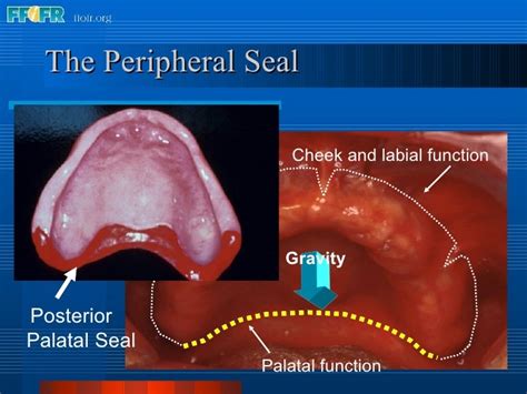 26posterior Palatal Seal