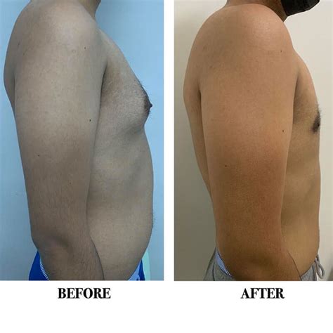 Slimbody Gynecomastia Compression Top Wizzgoo