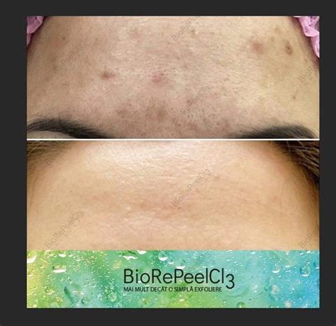 Bio Re Peel - Boss Beauty Group Ltd