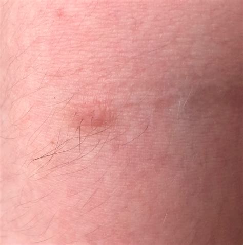 Бляшки на коже Вопрос дерматологу 03 Онлайн