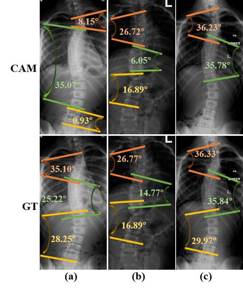 Deep Learning Techniques For Automatic Lateral X Ray Cephalometric