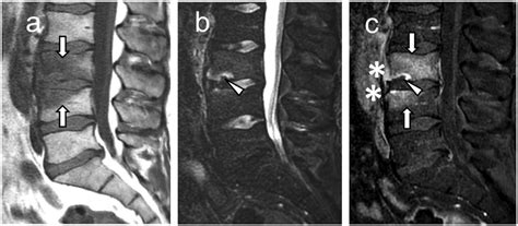 Sagital T1 A T2 B And Post Contrast Fat Saturated T1 Weighted Mr