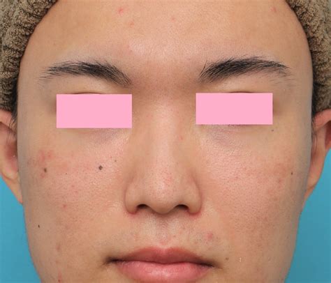 小鼻縮小手術を行った20代男性の経過画像です。 美容整形高須クリニック 高須 幹弥 オフィシャルブログ