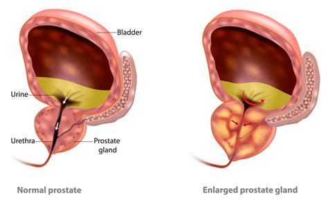 Does Ejaculation Frequency Influence Prostate Cancer Risk Steel