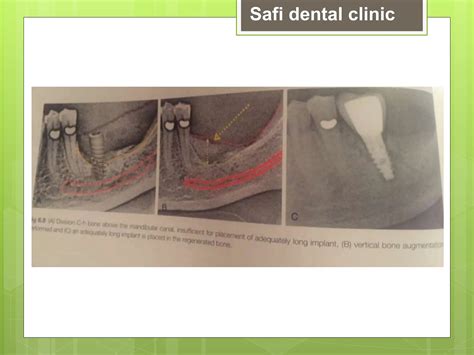 5 Bone Density For Dental Implants 5 Pptx 5 Bone Density For Dental Implants 5 Pptx