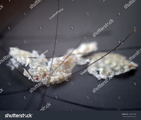 Dandruff Under A Microscope Query