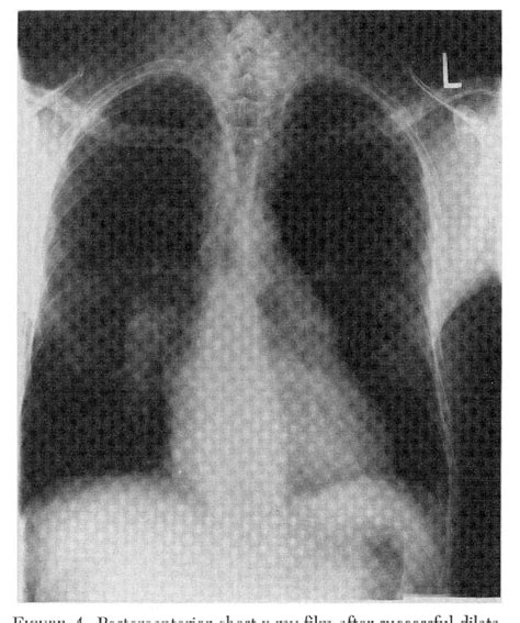 Figure 4 From A Posterior Mediastinal Mass Diagnosed By Echocardiogram