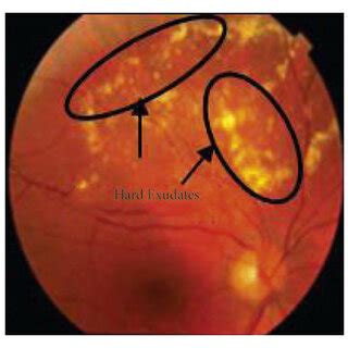 Retinal Images Showing A Hard Exudates And B Soft Exudates