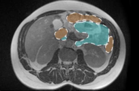 Figure 1 From Segmentation Of The Gastrointestinal Tract Mri Using Deep