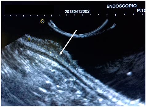 Eus Of Early Gastric Cancer At The Lesser Curvature Of The Gastric Eus Of Early Gastric Cancer At The Lesser Curvature Of The Gastric