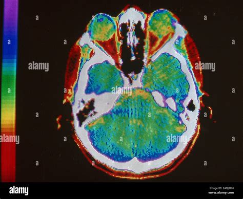 Colour Coded Image Of The Skull Produced By Computed Axial Tomography Known As A Cat Scan The