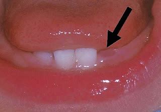 PORUR TOOTH CENTRE Teething Teething And Eruption