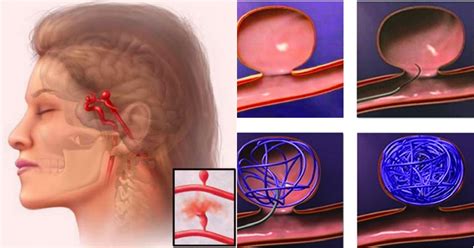 მილიონობით ადამიანს ეჭვიც კი არ აქვს რომ ის საშინელი მომაკვდინებელი დაავადებითაა შეპყრობილი