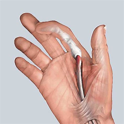 Trigger Finger Adelaide