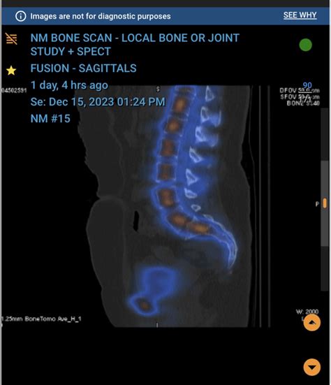 Spect Ct Scan R Askdocs