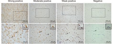 Expression Of Hcmv Pp65 Protein In Patients With Re The Pp65 Protein