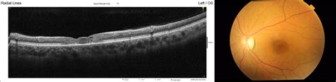 Fundus Photography Of The Left Eye Right And Sd Oct Macula Of The Download Scientific Diagram