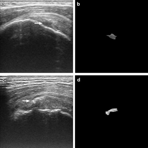 Extensor Carpi Ulnaris Synergy Test The Examiner Grasps The Patients