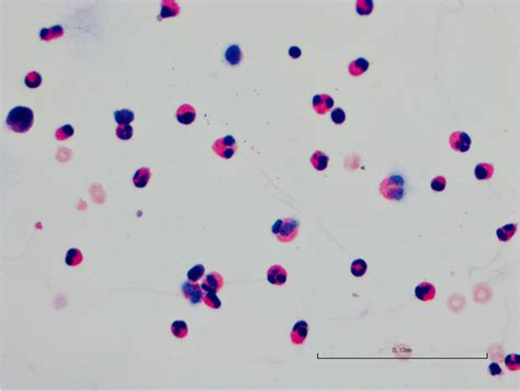 Eosinophilic Cells In Pd Effluent He Collected On An Olympus Bx51