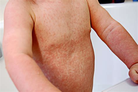 Top Viral Rashes In Babies Symptoms Causes And When To Seek Help