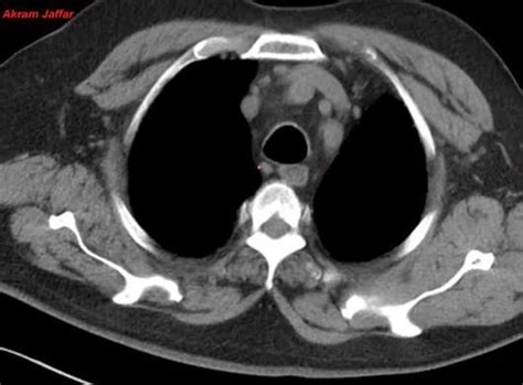 Cross Sectional And Ct Anatomy Thorax Flashcards Quizlet