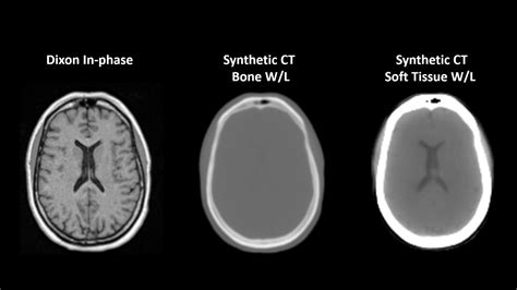 Mr Only Radiotherapy Planning Siemens Healthineers