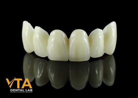 Accurate Understanding Of Anterior Bridge Vta Dental Lab