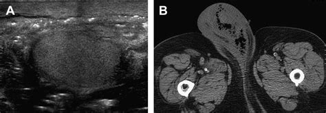Ultrasound Evaluation Of Scrotal Pathology Radiologic Clinics