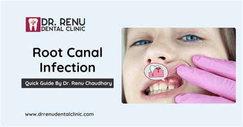 Knowing All About Root Canal Infection Dr Renu Dental Clinic