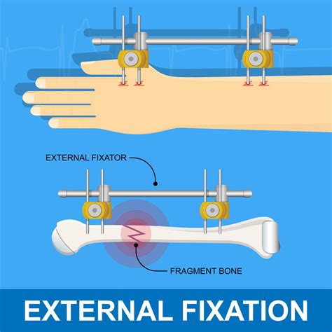 External Fixators In Orthopedics Types Benefits Risks And Daily