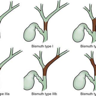 Bismuth Classifications Of Cholangiocarcinoma Download Scientific Diagram