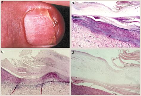 Histopathological Differential Diagnosis Of Nail Psoriasis And