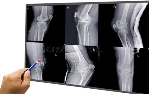 Ct Scan Knee Fracture Of Intercondylar Eminence Of Tibia Compression Fracture Of Posterior Of