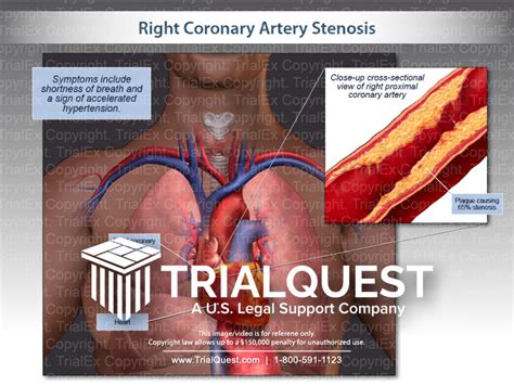 What Is Significant Narrowing Of Coronary Artery At Pedro Guevara Blog