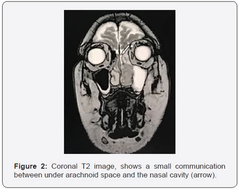 Journal Of Otolaryngology Open Access Journals