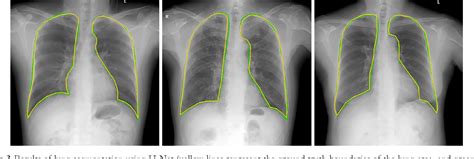 Figure 1 From Deep Learning Based Pulmonary Tuberculosis Automated Detection On Chest
