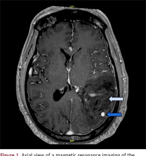 Figure 1 From The Silent Threat Bartonella Quintana Endocarditis