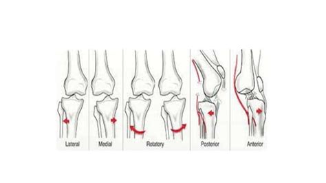 Knee Dislocation Pptx