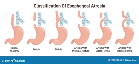 Gastric Outlet Obstruction Is A Condition In Which There Is A