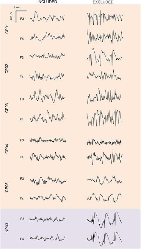 Integrity Of Corpus Callosum Is Essential For The Cross Hemispheric