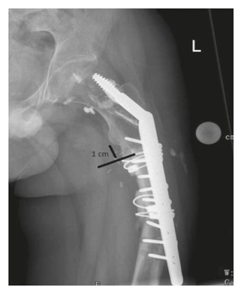A Mri Of Right Tibia Of Patient With A Tibial Osteosarcoma With Download Scientific Diagram