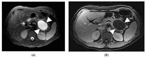 The Role Of Magnetic Resonance Imaging Mri In The Diagnosis Of
