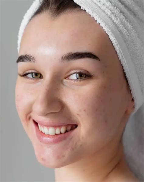 Skin Pigmentation Treatment In Vile Parle Mumbai