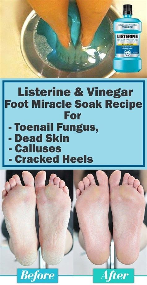 Toenail Fungus Vinegar Before And After Nail Treatment Progression Photo Before And After By