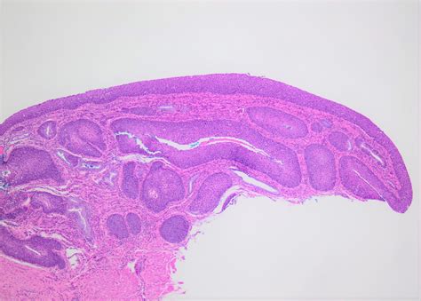 Normal Transformation Zone Histology Cervix Cervix
