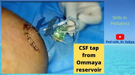 Csf Tap Procedure From Ommaya Reservoir Ommaya Tap Decreasing Rict In