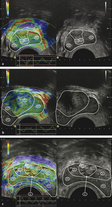 Elastography Of The Prostate Radiology Key