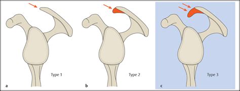 Acromion Types